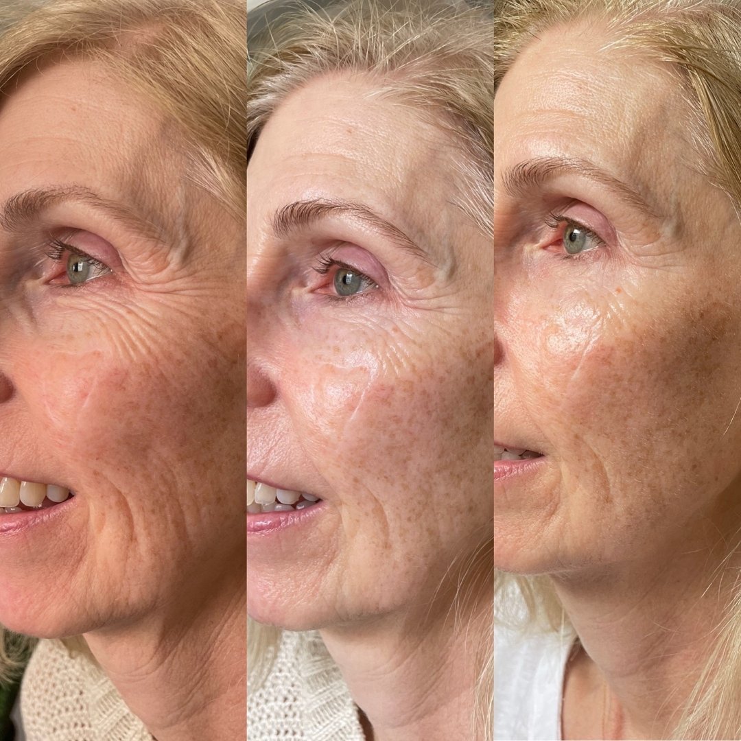 6 Tips For Getting Better Results With The KRX V-Tox Facial – by Kin ...