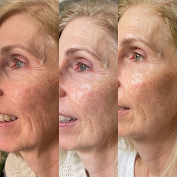 6 Tips For Getting Better Results With The KRX V-Tox Facial – by Kin ...
