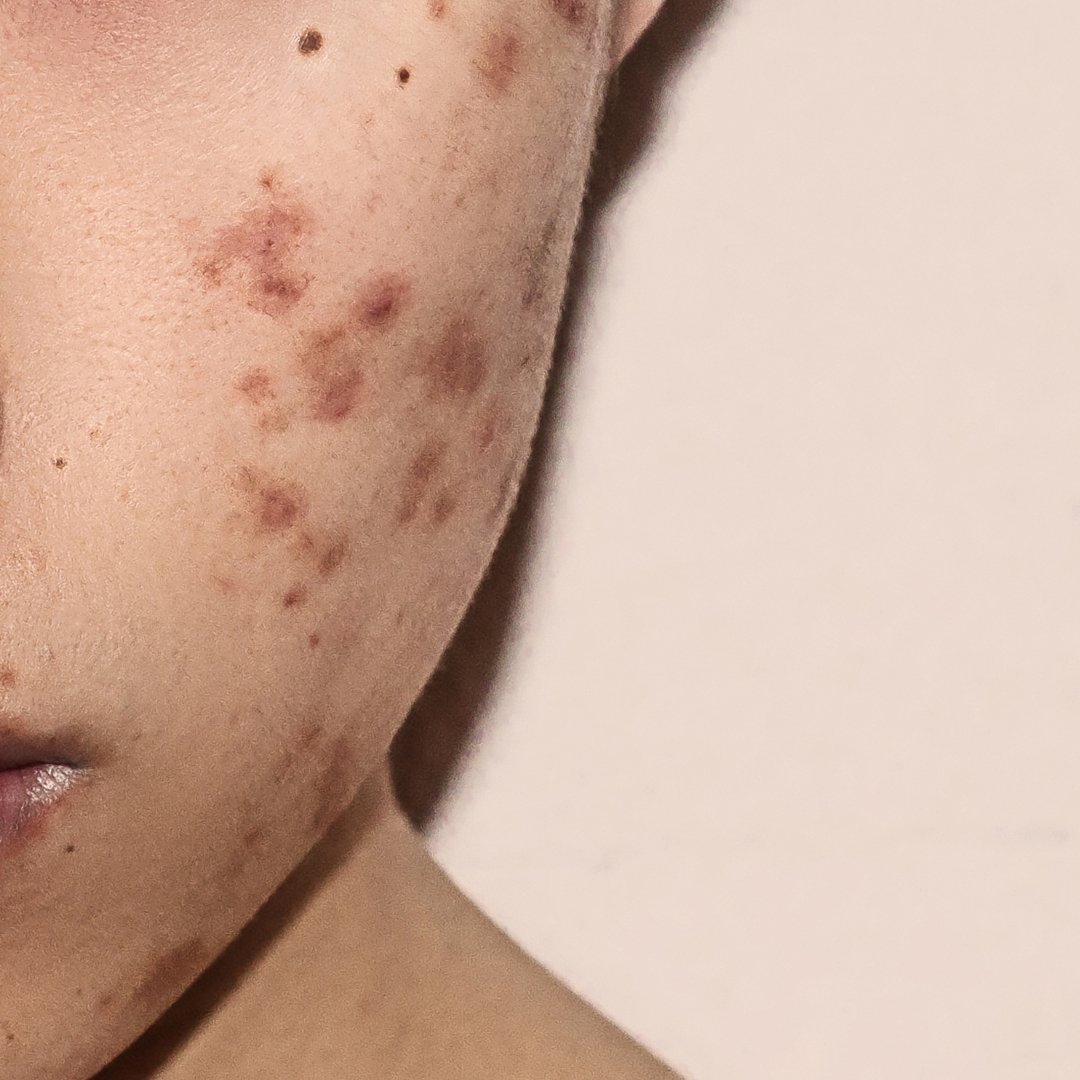 Clearing The Path: Why the First Acne Facial Appointment Comes at a Pr ...